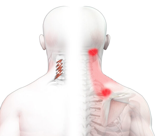 De Online Pijngids – Symptoomchecker voor klachten die door spieren ...