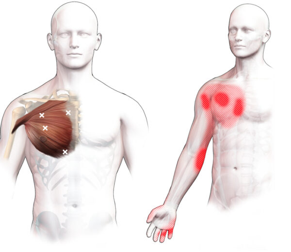 De Online Pijngids – Symptoomchecker voor klachten die door spieren ...