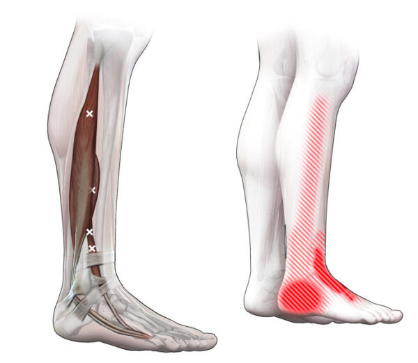 Pijn onderbeen – De Online Pijngids