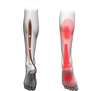 Pijn onderbeen – De Online Pijngids